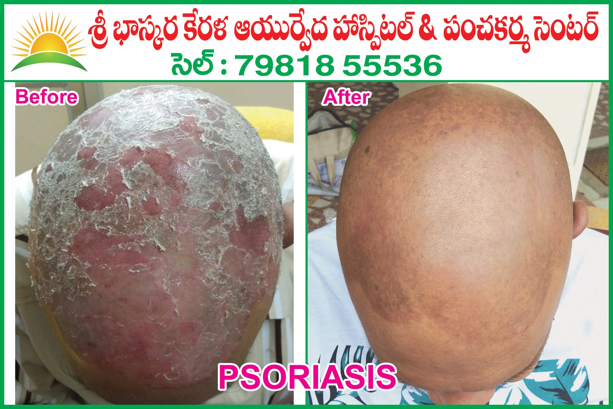 Psoriasis - Sri Bhaskara Kerala Ayurvedic Hospitals