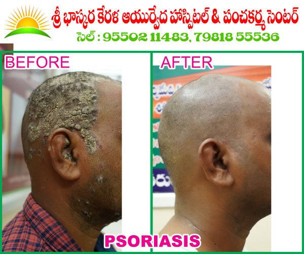 Psoriasis - Sri Bhaskara Kerala Ayurvedic Hospitals