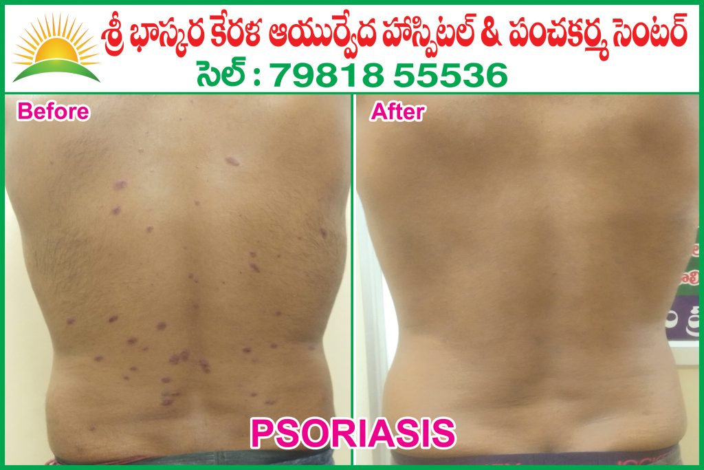 Psoriasis - Sri Bhaskara Kerala Ayurvedic Hospitals